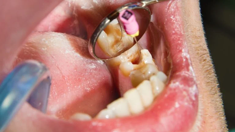 Root Canal (RCT) - Dr Kiran Haseeb