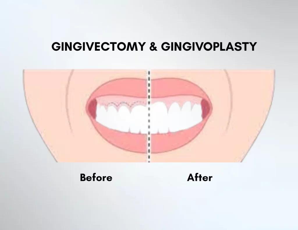 Gingivectomy & Gingivoplasty | Dr Kiran Haseeb